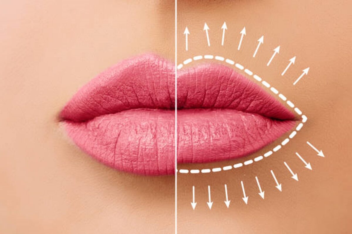 Lip Dermal Filler - North Cotswolds Aesthetics | Award Winning Treatments